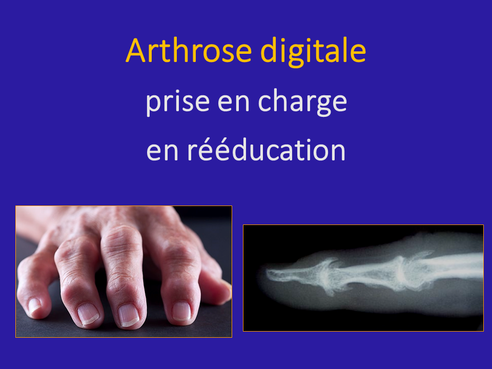 Arthrose digitale - Denis GERLAC - Rééducation et Orthèses de la Main ...