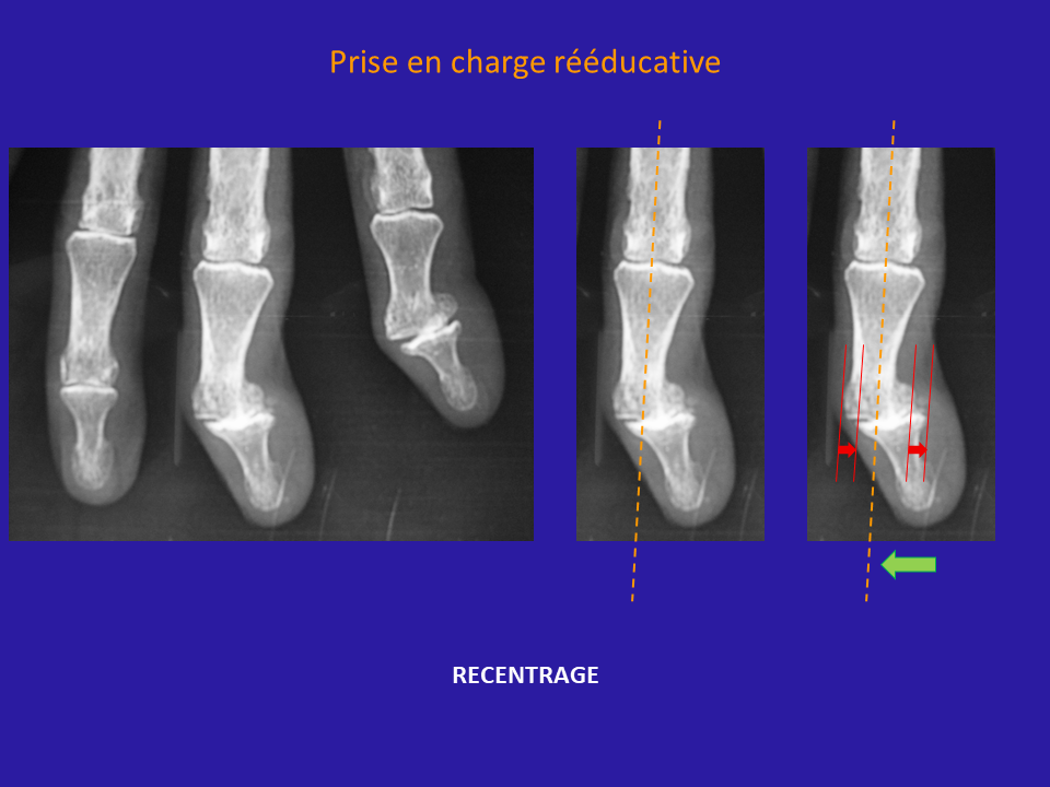 Arthrose-doigt-10-kinesitherapie-traitement-rééducation- Denis GERLAC ...