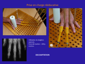 Arthrose digitale - Denis GERLAC - Rééducation et Orthèses de la Main ...