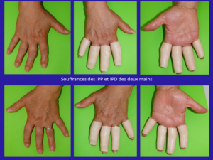 Arthrose digitale - Denis GERLAC - Rééducation et Orthèses de la Main ...