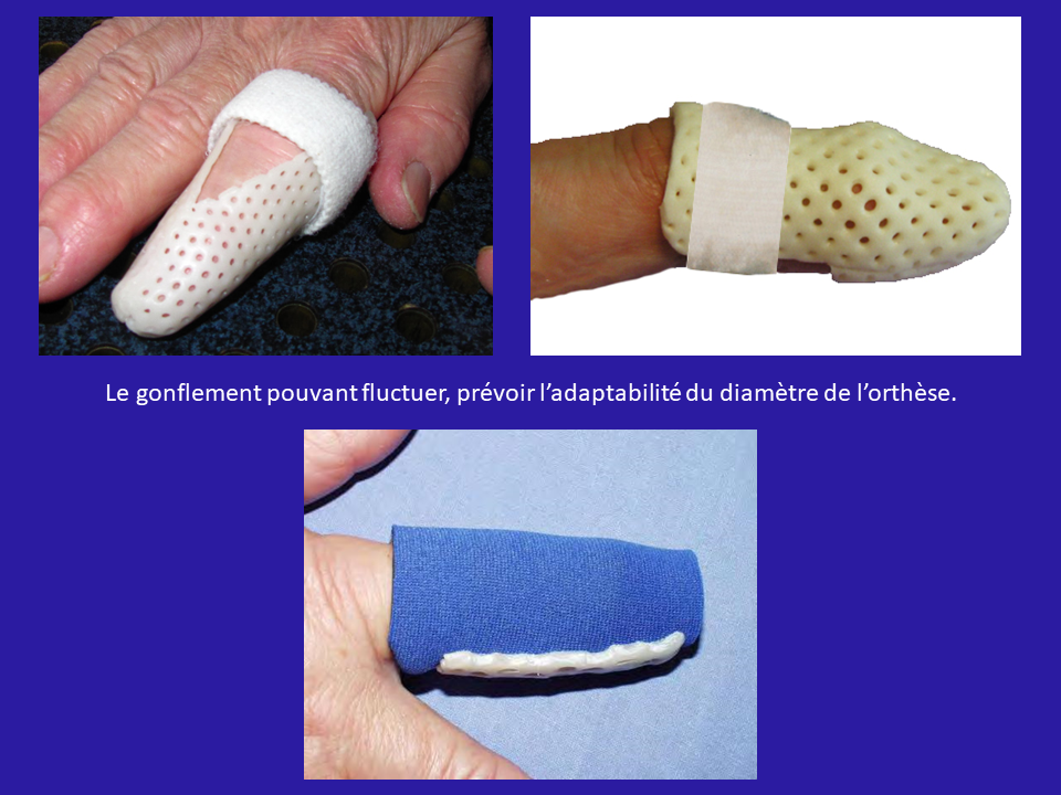 Arthrose-doigt-16-rééducation-grenoble-grenoble-grenoble - Denis GERLAC ...
