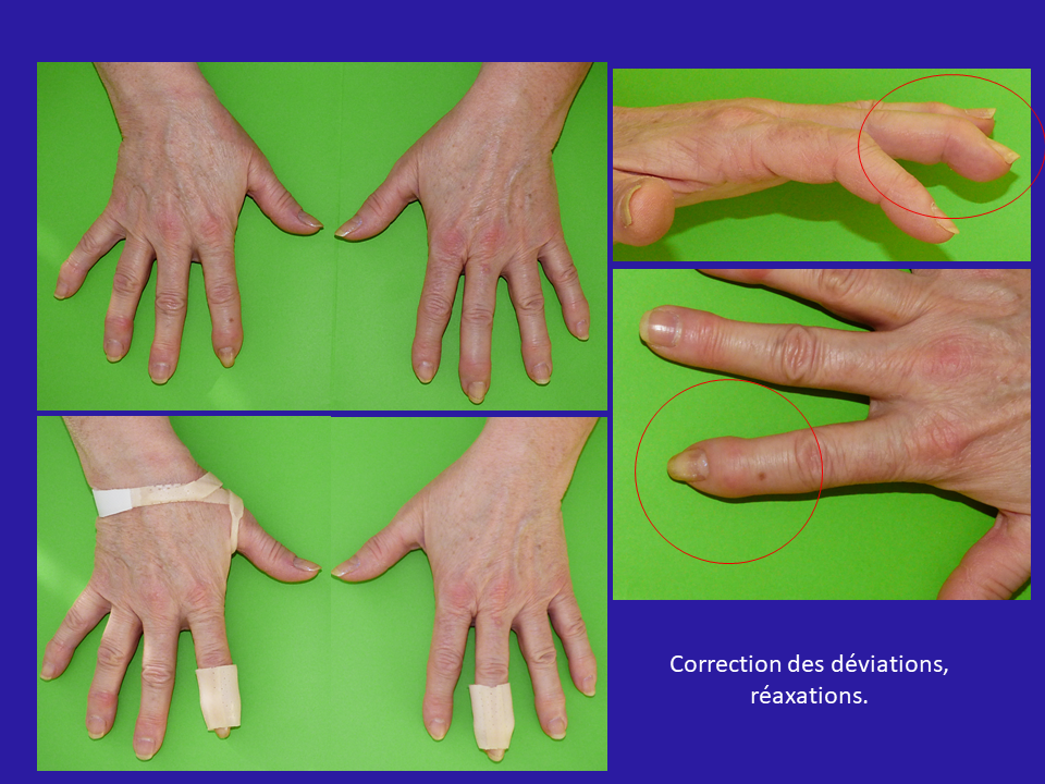 Arthrose digitale - Denis GERLAC - Rééducation et Orthèse de la Main et ...