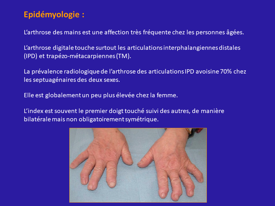 Arthrose-doigt-3-rééducation-orthese-attelle-kinesitherapie - Denis ...