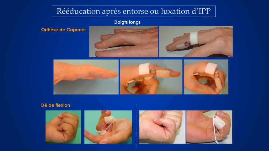 Rééducation après luxation de doigt (IPP) - Denis GERLAC - Rééducation ...