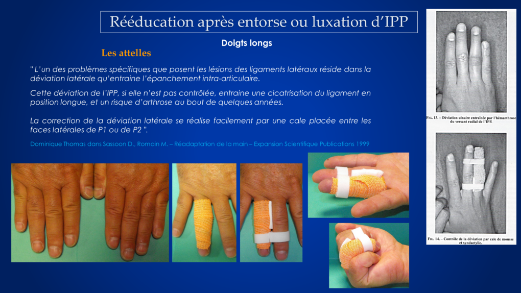 entorse-doigt-attelle-entorse-doigt-attelle-1 - Denis GERLAC ...