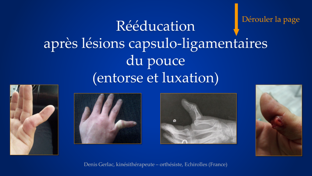entorse-pouce-entorse-pouce-entorse-pouce-2 - Denis GERLAC ...