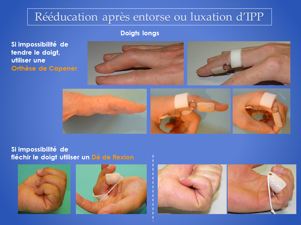 Rééducation après luxation de doigt (IPP) - Denis GERLAC - Rééducation ...