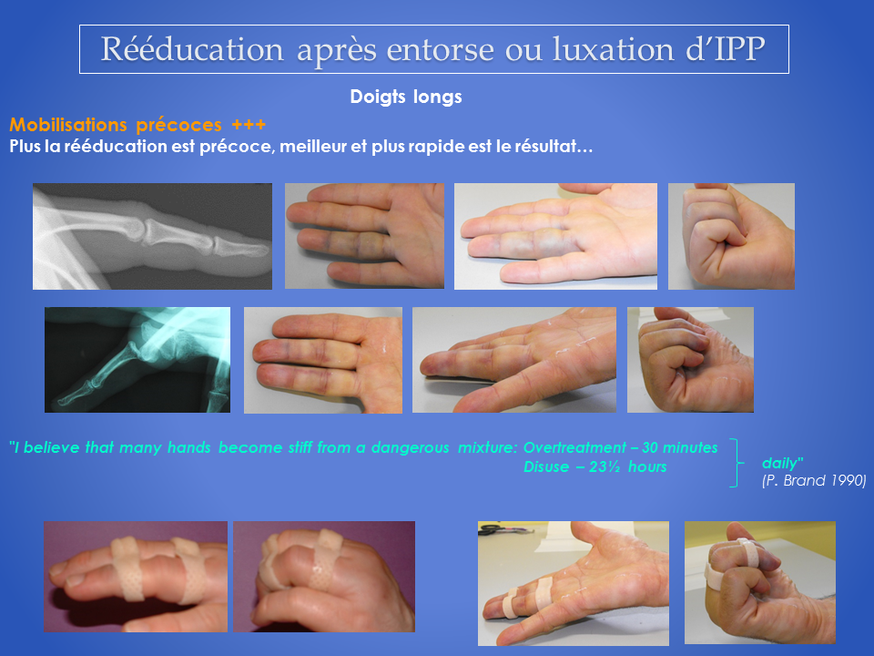 Rééducation après luxation de doigt (IPP) - Denis GERLAC - Rééducation ...