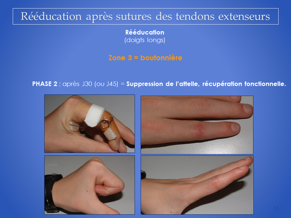Rééducation après lésion des tendons extenseurs des doigts - Denis ...