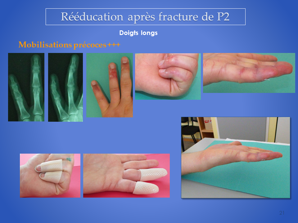 Rééducation après fracture de phalange de doigt long - Denis GERLAC ...