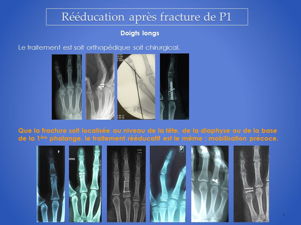 Rééducation après fracture de phalange de doigt long - Denis GERLAC ...