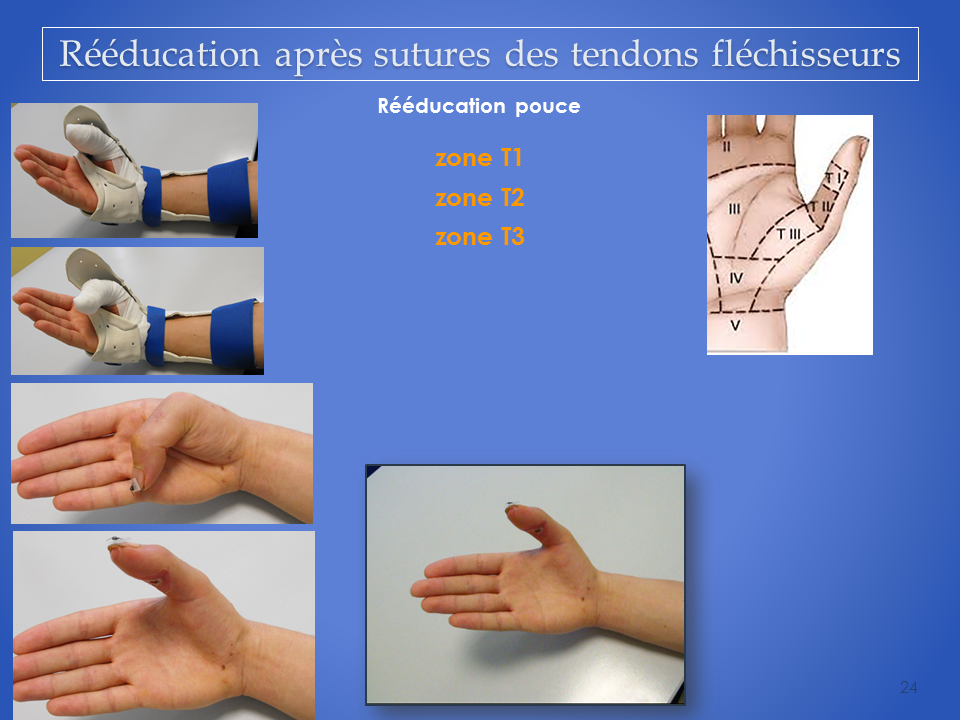 Rééducation après lésion tendons fléchisseurs des doigts - Denis GERLAC ...