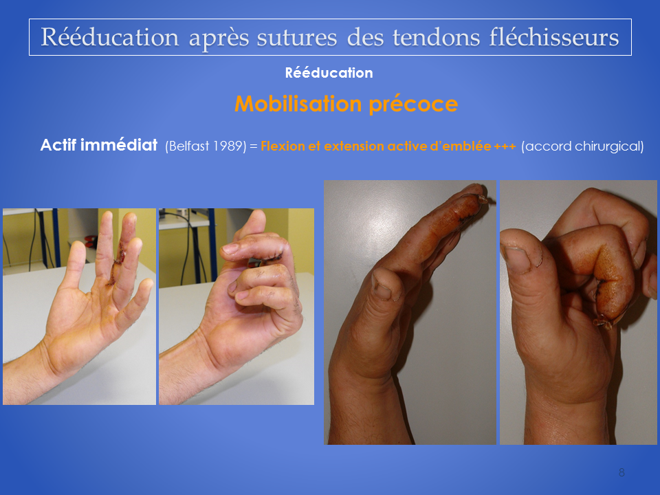Rééducation après lésion tendons fléchisseurs des doigts - Denis GERLAC ...