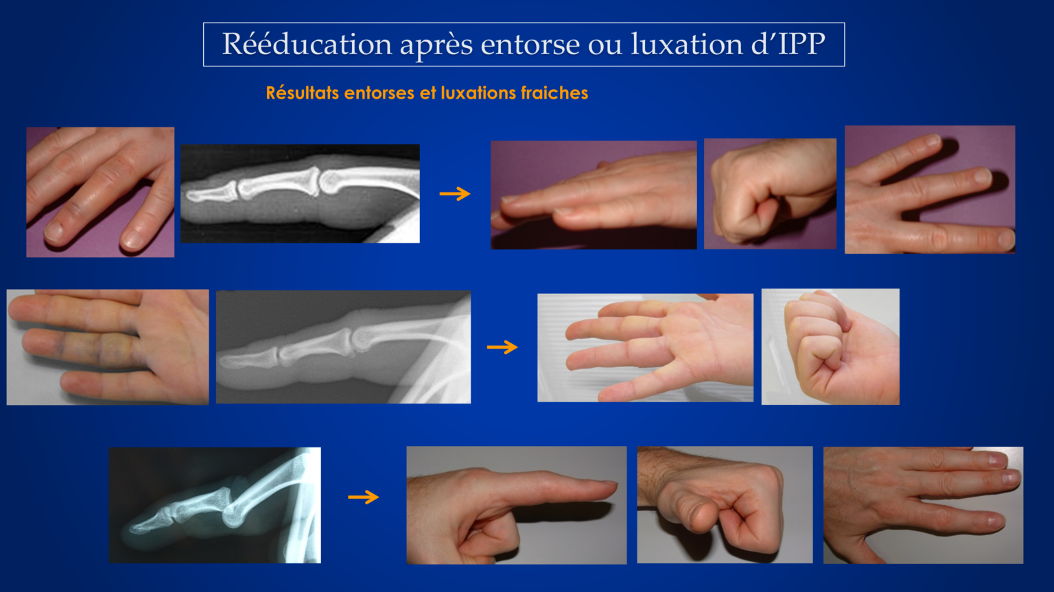 Rééducation après luxation de doigt (IPP) - Denis GERLAC - Rééducation ...