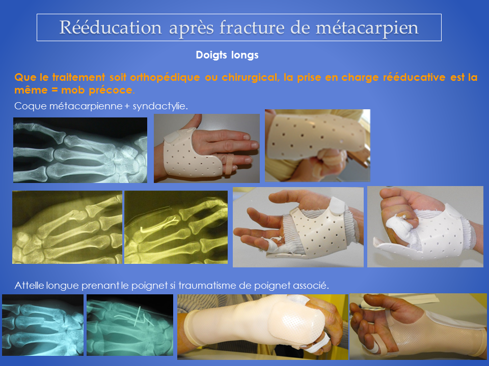 Reprise Sport Apres Fracture 5Eme Metatarse at Layla Swallow blog