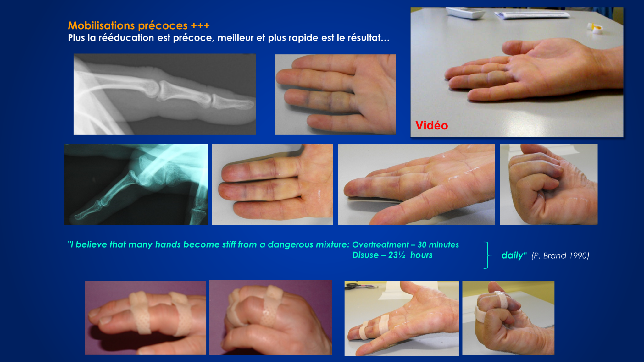 Rééducation après luxation de doigt (IPP) - Denis GERLAC - Rééducation ...